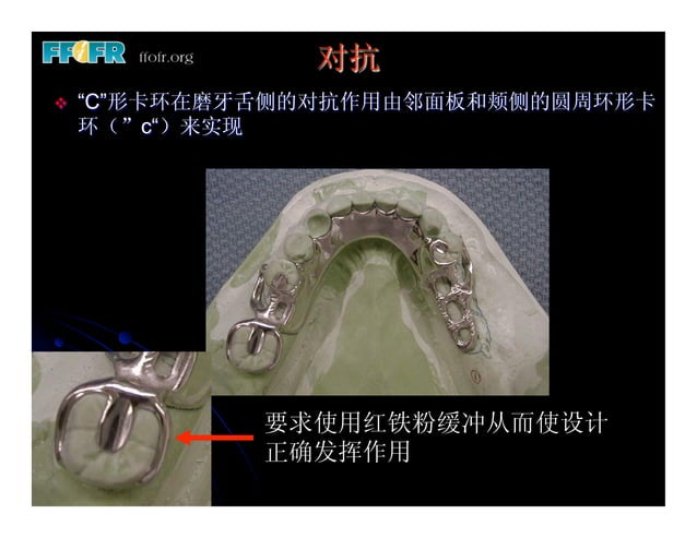 5.retainers, clasp assemblies and indirect retainers | PPT