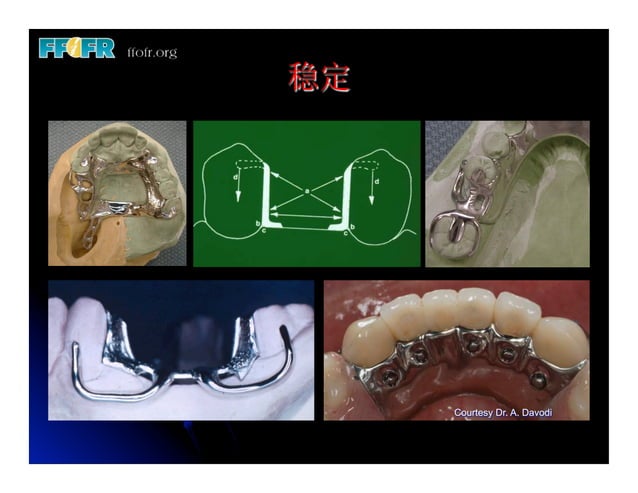 5.retainers, clasp assemblies and indirect retainers | PPT