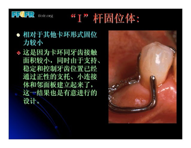 5.retainers, clasp assemblies and indirect retainers | PPT