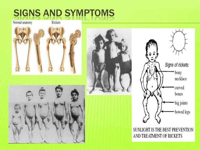 rickets . serrano | PPTX