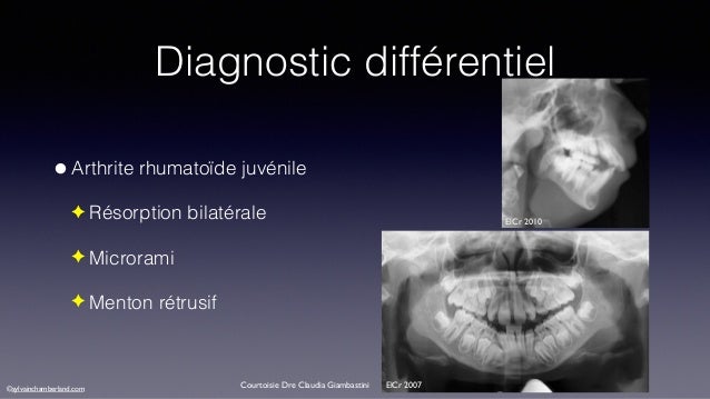 Resorption condylienne idiopathique et arthrose des ATM