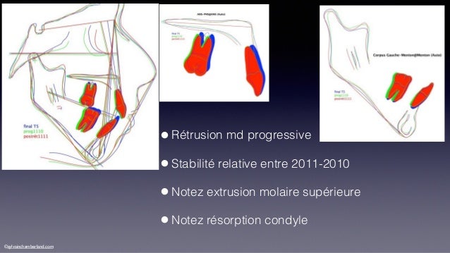 Resorption condylienne idiopathique et arthrose des ATM
