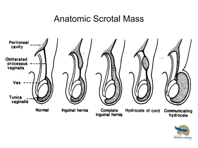 Scrotal masses and Testicular tumors | PPT