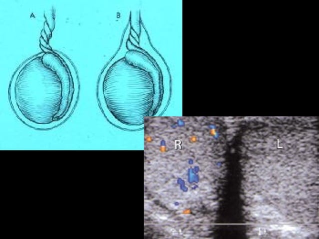 Scrotal masses and Testicular tumors | PPT