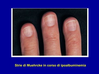 5. sindrome nefrosica | PPT