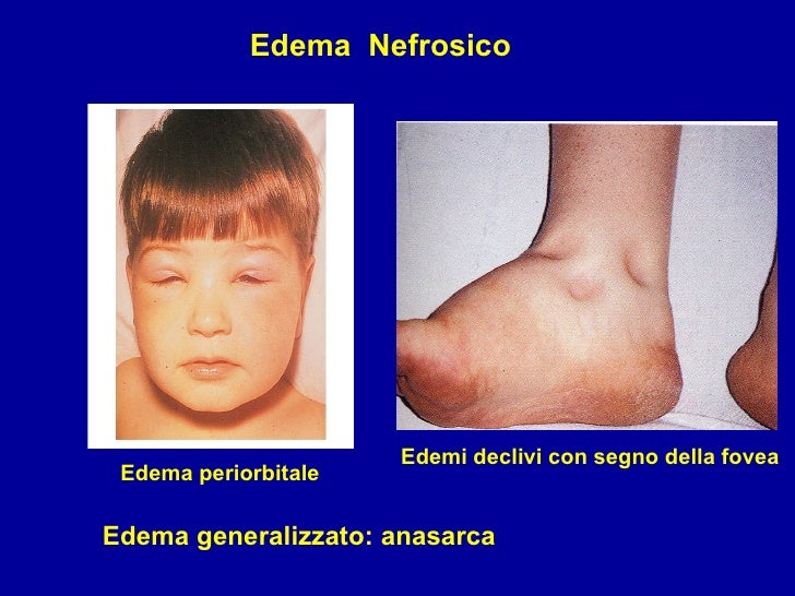 5. sindrome nefrosica