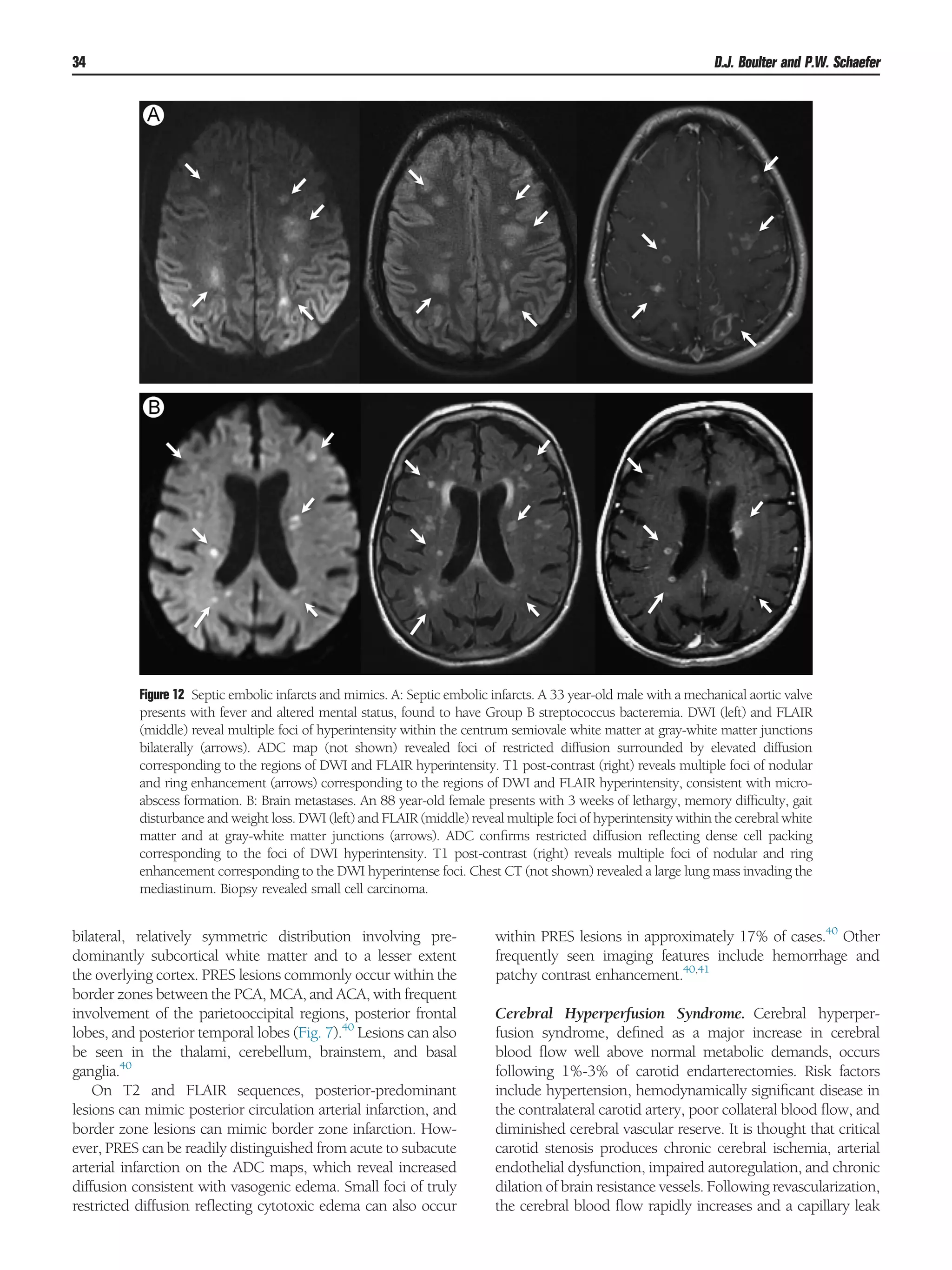 Stroke and stroke mimics | PDF