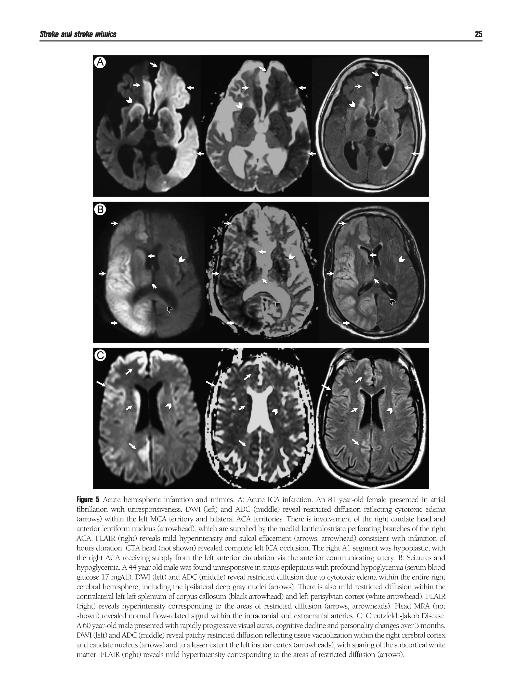 Stroke and stroke mimics | PDF