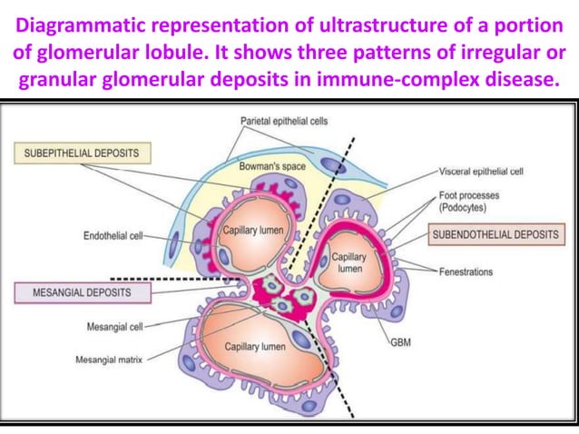 The Kidney - GLOMERULAR DISEASES | PPTX | Blood Disorders | Diseases and Conditions