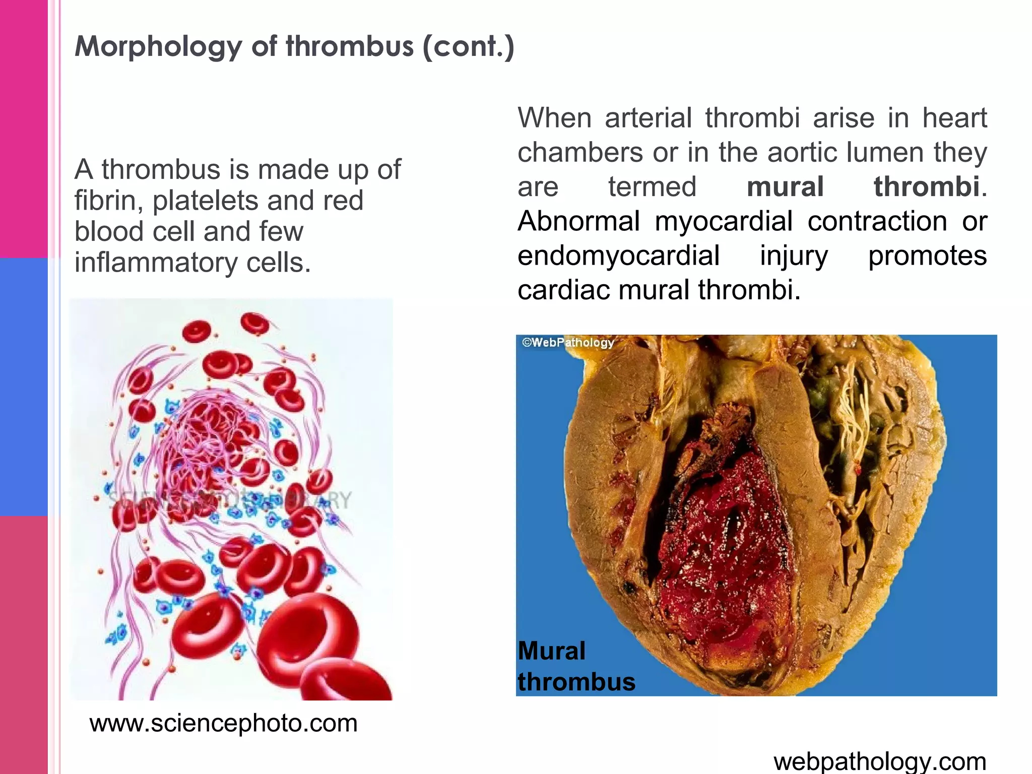 CVS Pathology 5 Thromboembolism 2019, sufia husain | PPT