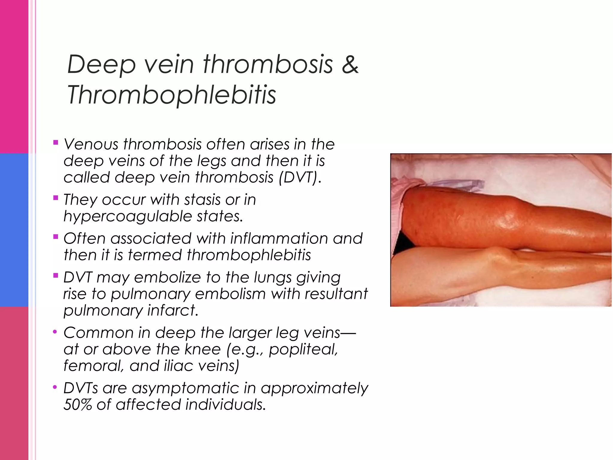 CVS Pathology 5 Thromboembolism 2019, sufia husain | PPT