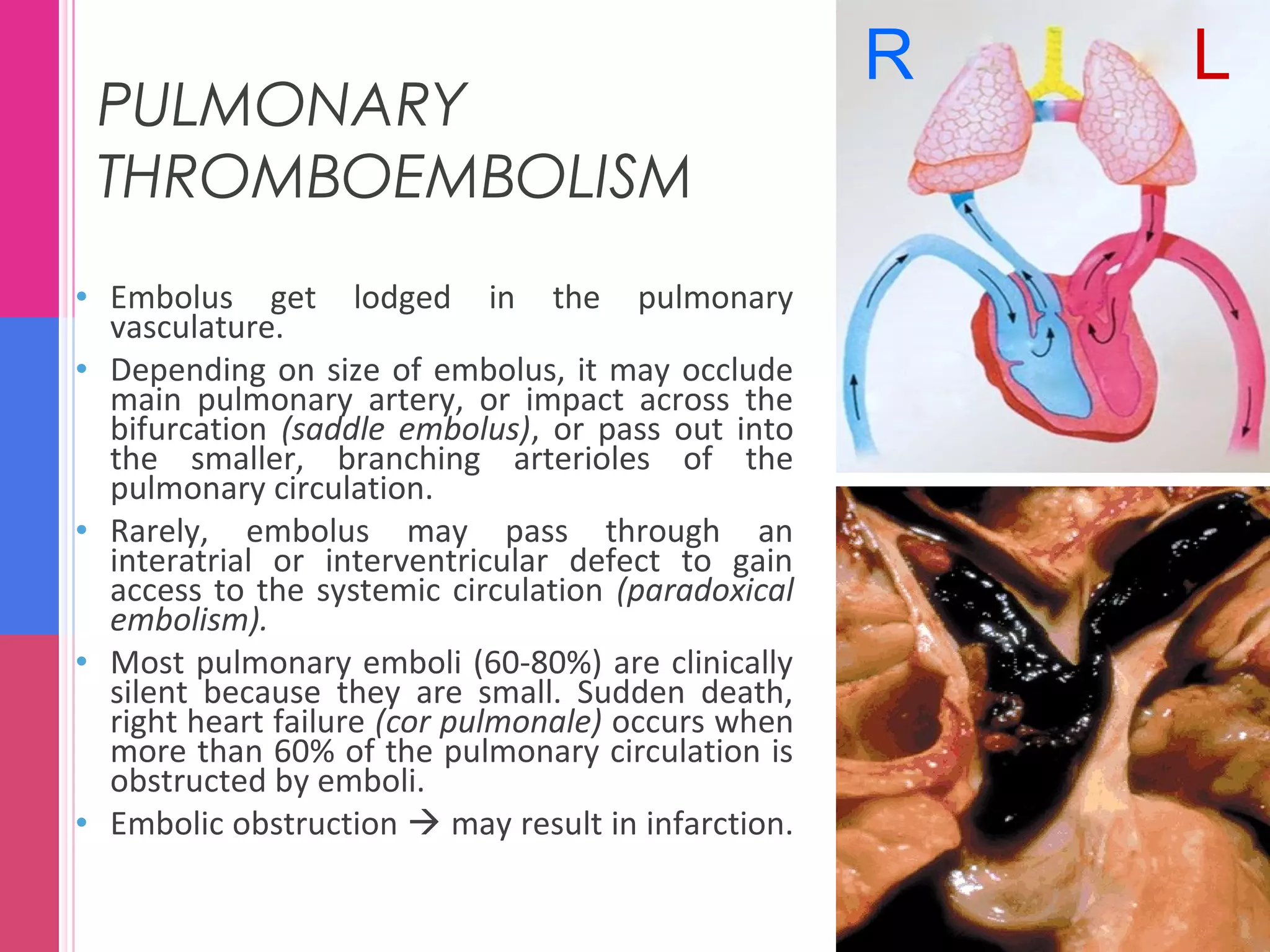 CVS Pathology 5 Thromboembolism 2019, sufia husain | PPT