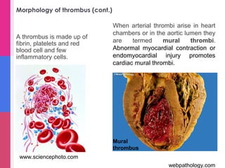 CVS Pathology 5 Thromboembolism 2019, sufia husain | PPT