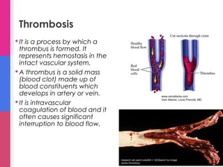 CVS Pathology 5 Thromboembolism 2019, sufia husain | PPT