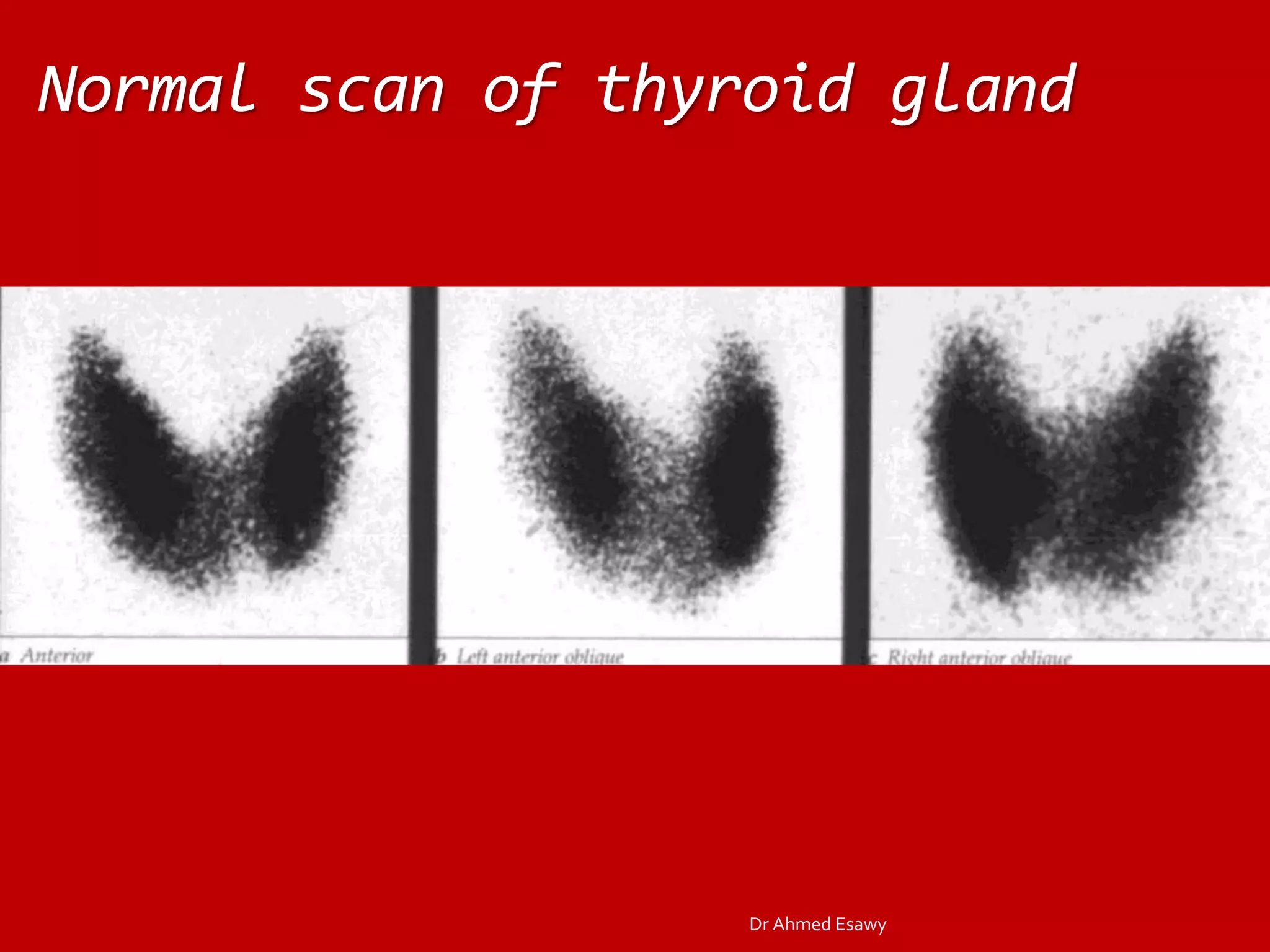 thyriod gland imaging part 5 (molecular imaging nuclear imaging spect ...