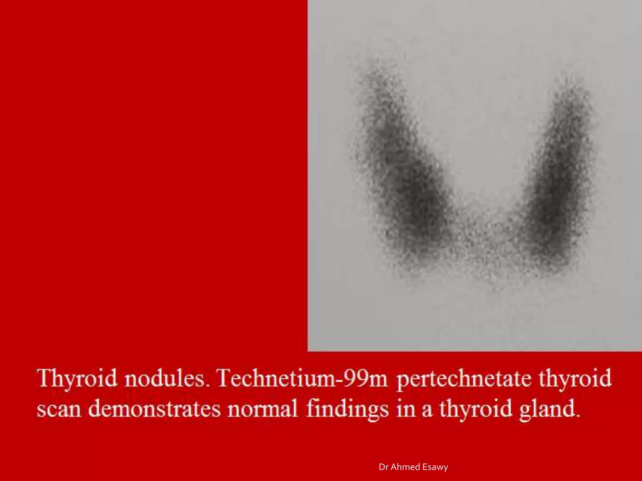 thyriod gland imaging part 5 (molecular imaging nuclear imaging spect ...