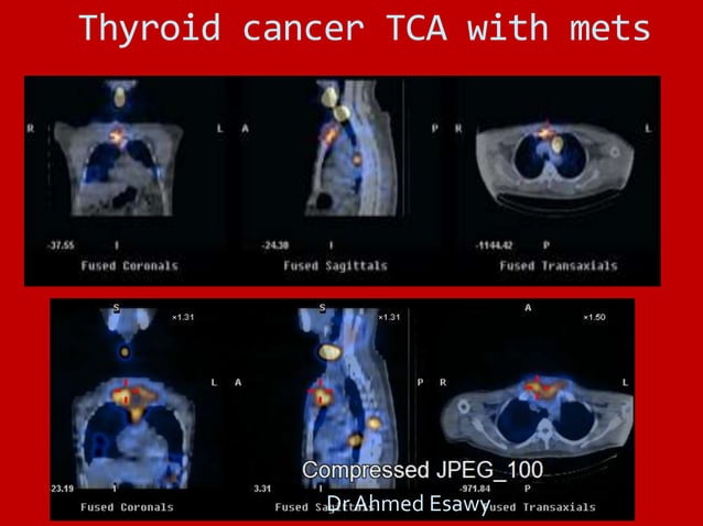 thyriod gland imaging part 5 (molecular imaging nuclear imaging spect ...