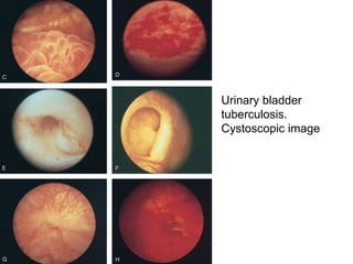5-Urology- Uti.pptx