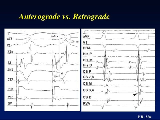 Wolff - Parkinson - White Syndrome