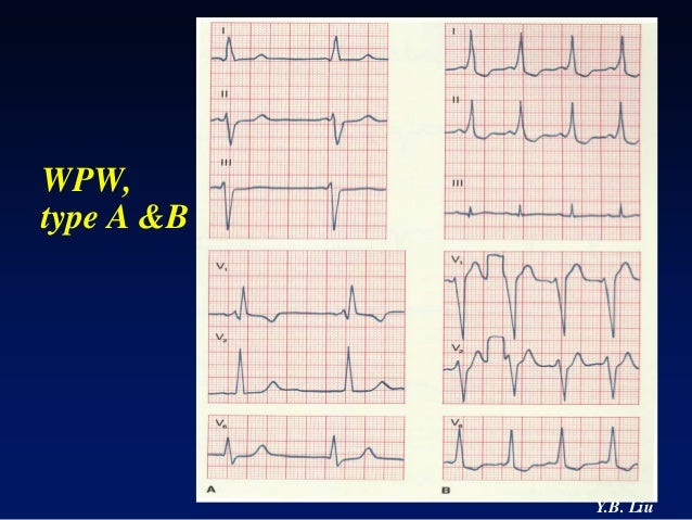 Wolff - Parkinson - White Syndrome
