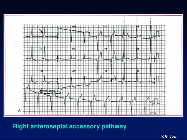 Wolff - Parkinson - White Syndrome