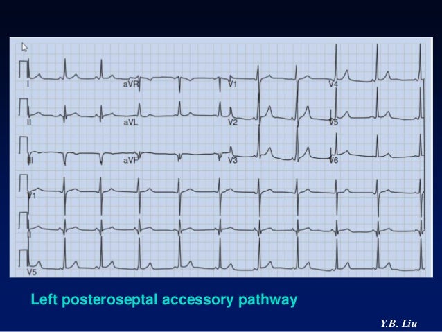 Wolff - Parkinson - White Syndrome