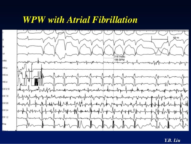 Wolff - Parkinson - White Syndrome