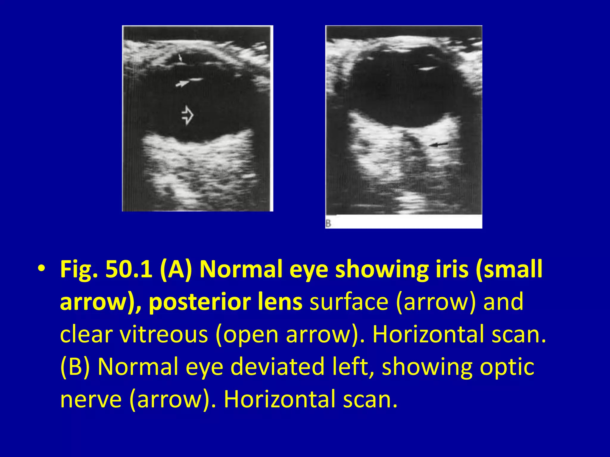 50 DAVID SUTTON PICTURES ULTRASOUND OF THE EYE AND ORBIT | PPTX