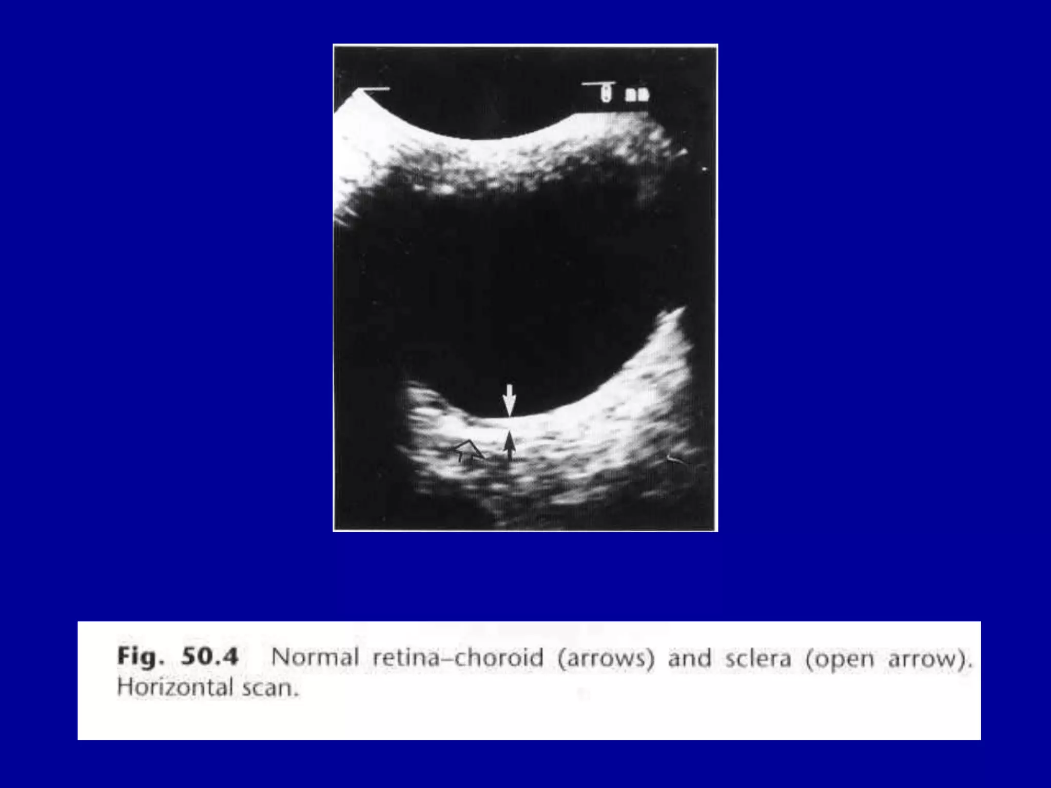 50 DAVID SUTTON PICTURES ULTRASOUND OF THE EYE AND ORBIT | PPTX