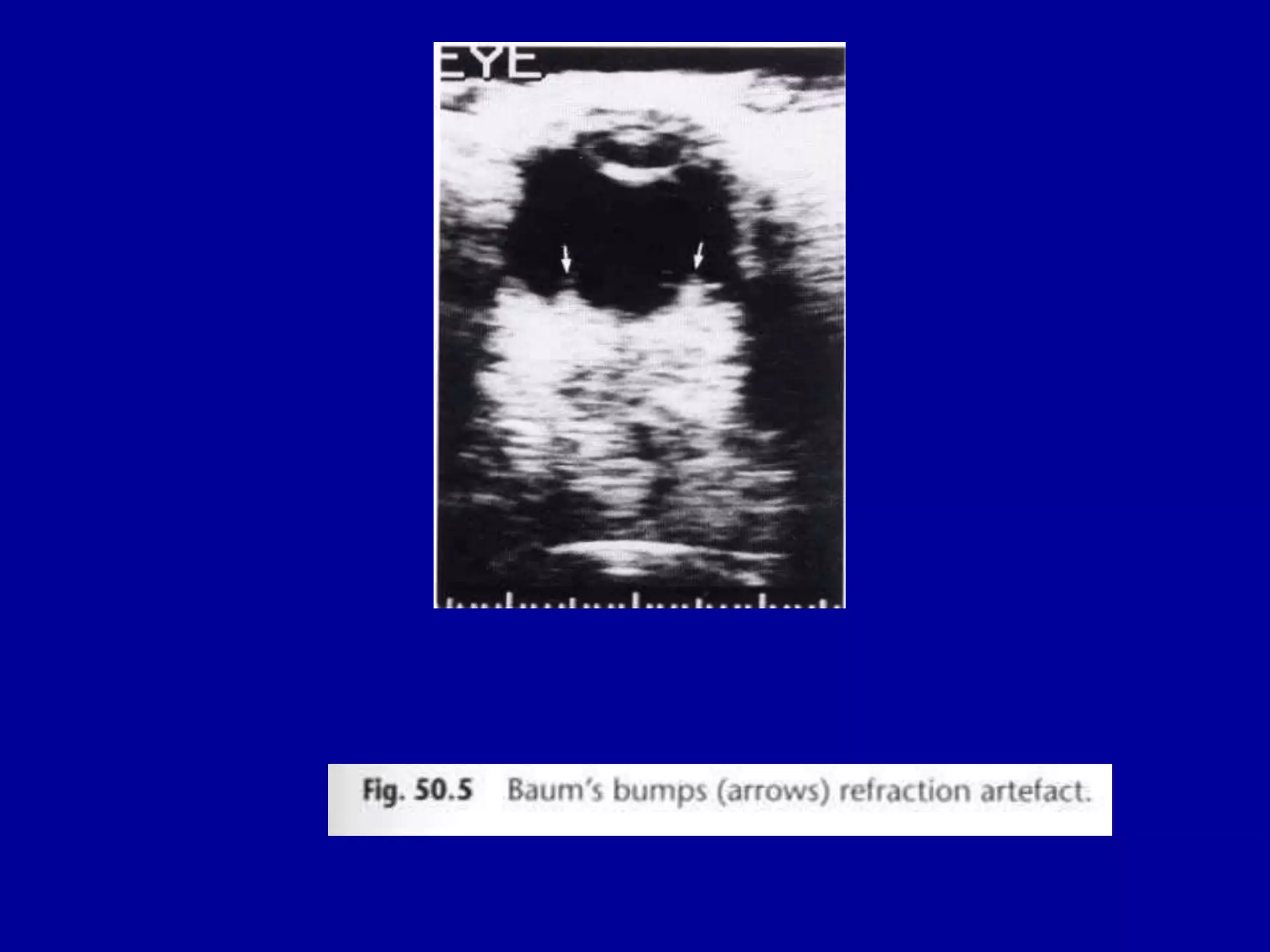 50 DAVID SUTTON PICTURES ULTRASOUND OF THE EYE AND ORBIT | PPTX