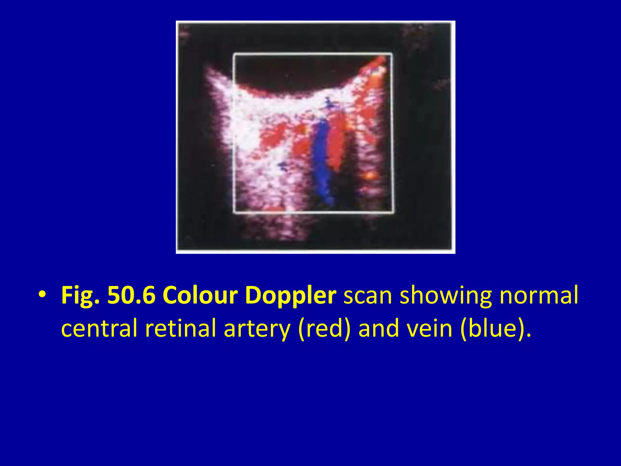 50 DAVID SUTTON PICTURES ULTRASOUND OF THE EYE AND ORBIT | PPTX