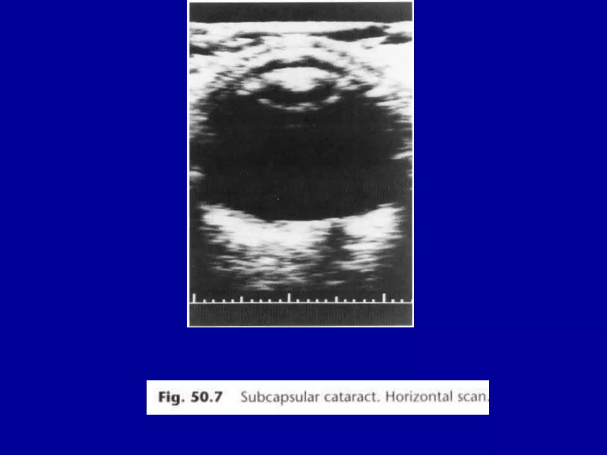 50 DAVID SUTTON PICTURES ULTRASOUND OF THE EYE AND ORBIT | PPTX