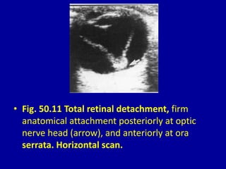 50 DAVID SUTTON PICTURES ULTRASOUND OF THE EYE AND ORBIT | PPTX