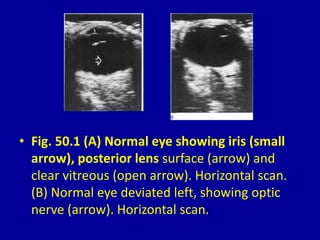 50 DAVID SUTTON PICTURES ULTRASOUND OF THE EYE AND ORBIT | PPTX