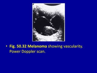 50 DAVID SUTTON PICTURES ULTRASOUND OF THE EYE AND ORBIT | PPTX