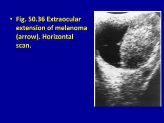 50 DAVID SUTTON PICTURES ULTRASOUND OF THE EYE AND ORBIT | PPTX
