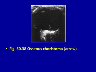50 DAVID SUTTON PICTURES ULTRASOUND OF THE EYE AND ORBIT | PPTX