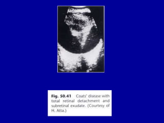 50 DAVID SUTTON PICTURES ULTRASOUND OF THE EYE AND ORBIT | PPTX