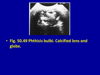 50 DAVID SUTTON PICTURES ULTRASOUND OF THE EYE AND ORBIT | PPTX