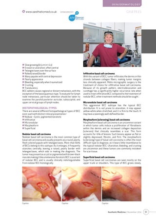 Treating basal cell cancer by surgical excision | PDF