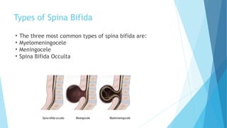 504026522-spina-bifida-powerpoint.pptx_20250714_010516_0000.pptx