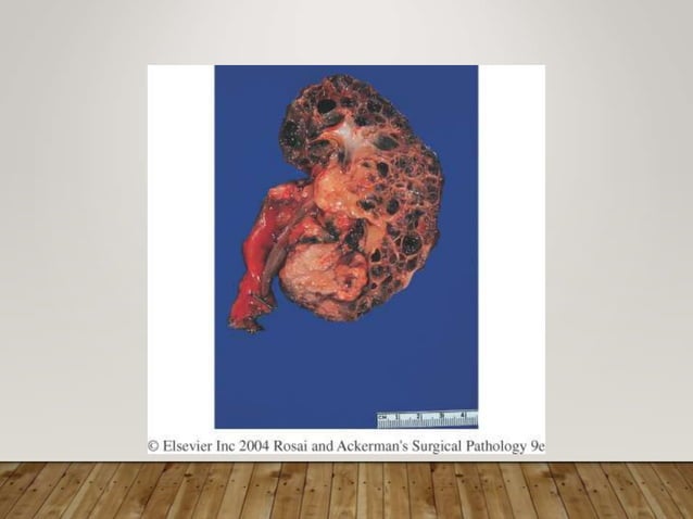 Kidney tumors/ renal tumors - malignant benign | PPT | Blood Disorders ...