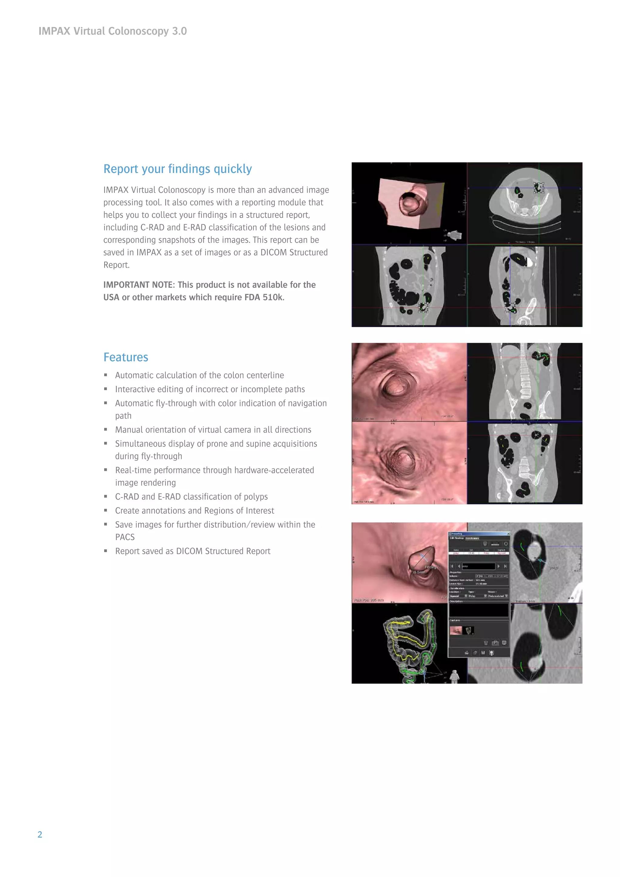 IMPAX_Virtual_Colonoscopy_(GB_-_datasheet) | PDF