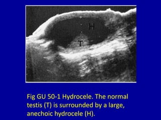 50 fluid collection in the scrotum | PPTX