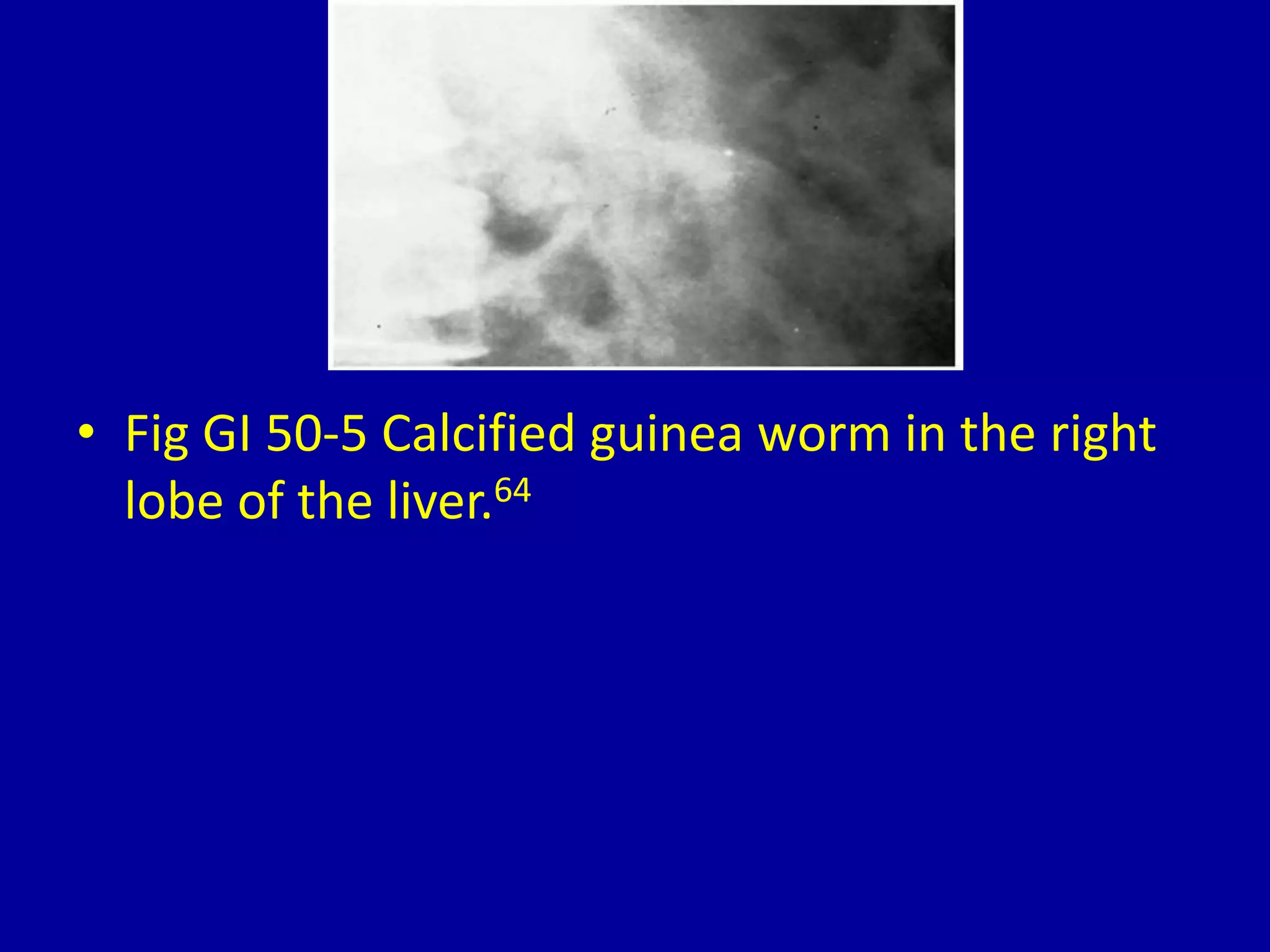 50 liver calcification | PPTX