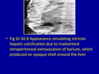 50 liver calcification | PPTX | Medical Health