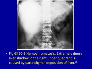 50 liver calcification | PPTX | Medical Health