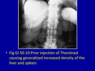 50 liver calcification | PPTX | Medical Health