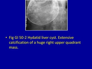 50 liver calcification | PPTX