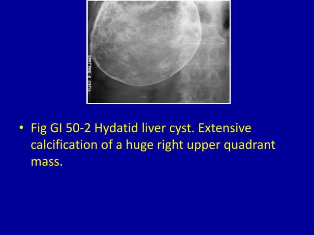 50 liver calcification | PPTX | Medical Health